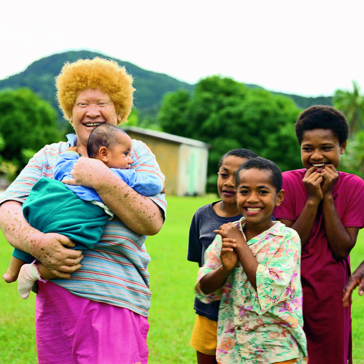 Albinism - Positive Exposure