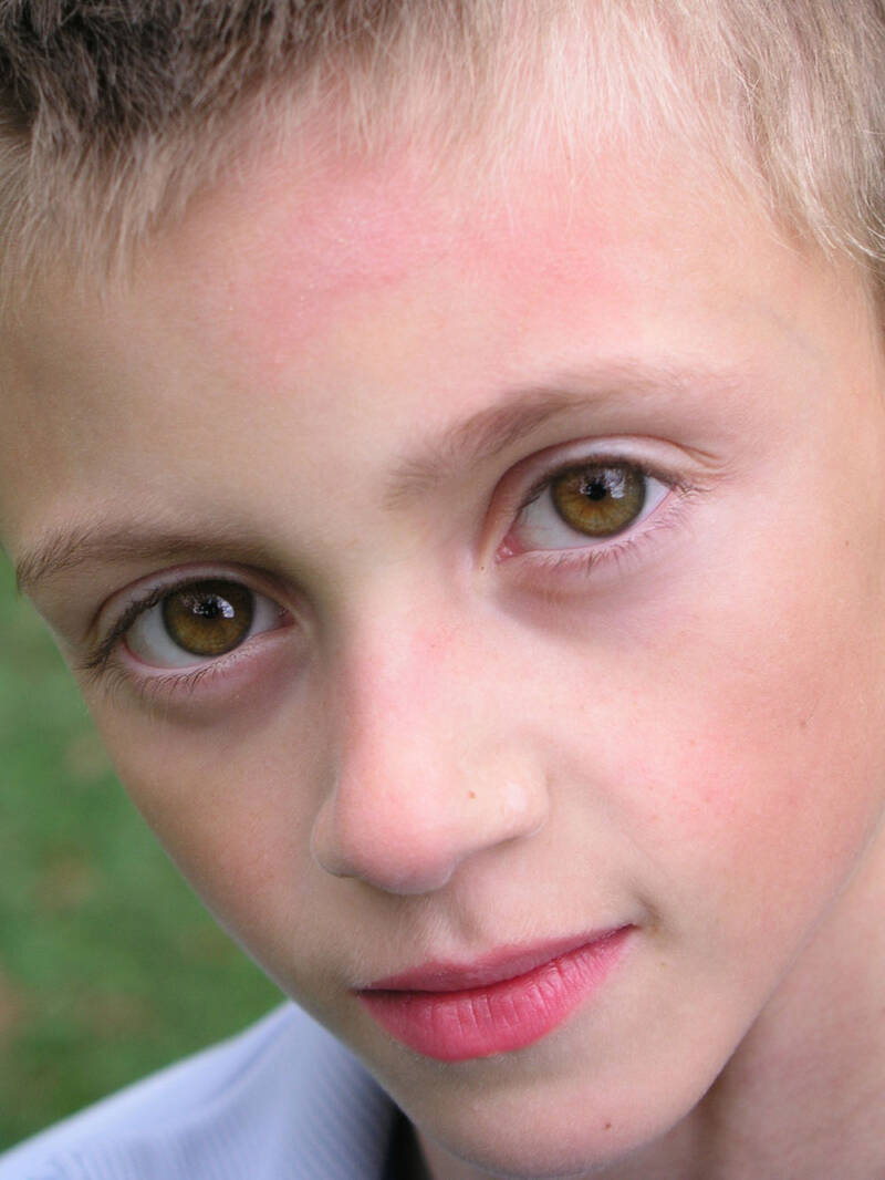 Proteus Syndrome - Positive Exposure