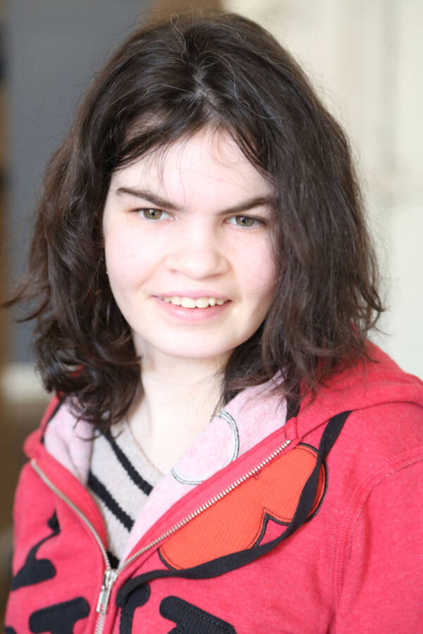 Chromosome 5P-, Cri Du Chat Syndrome - Positive Exposure
