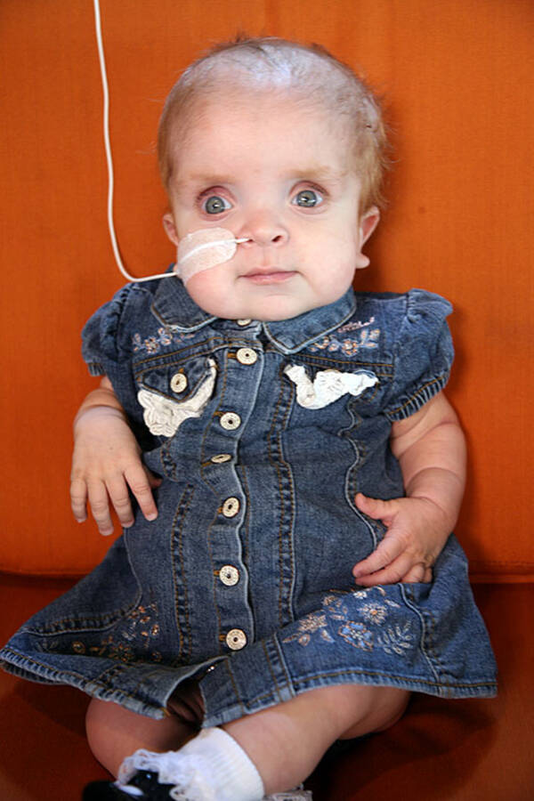 Costello Syndrome - Positive Exposure