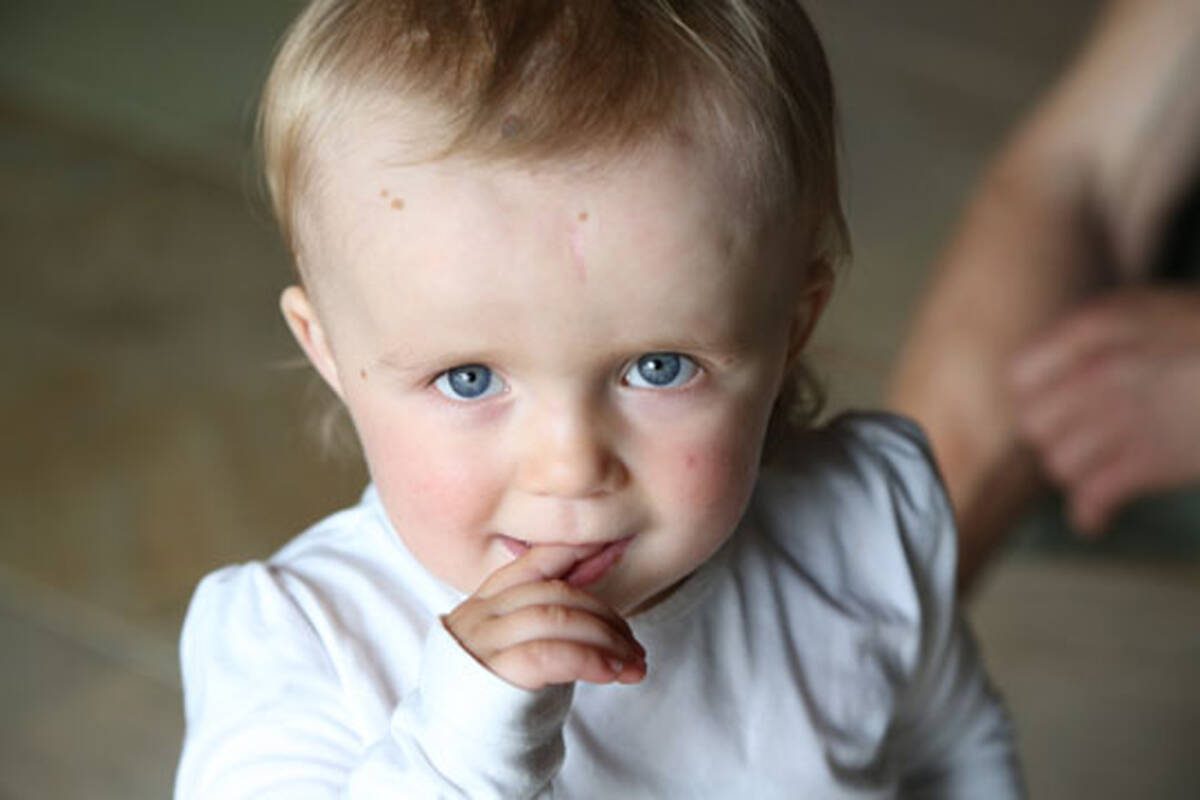 Nevus: Congenital Melanocytic Nevus - Positive Exposure