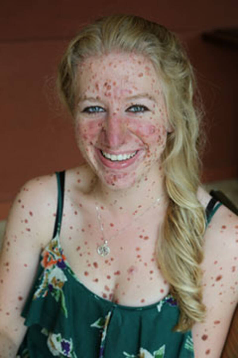 Nevus: Congenital Melanocytic Nevus - Positive Exposure