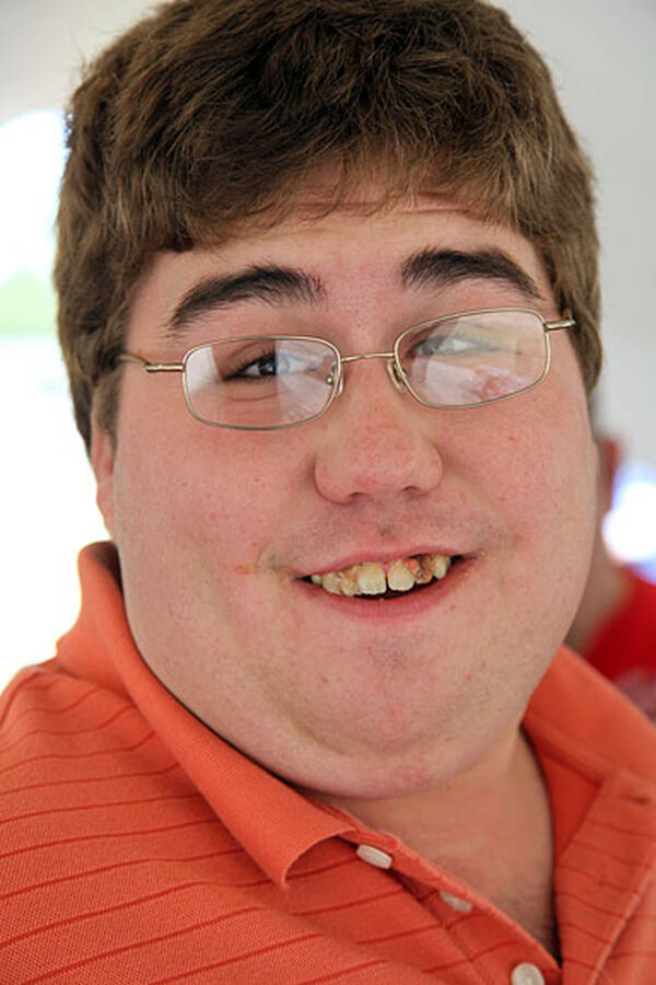 Smith-Magenis Syndrome - Positive Exposure