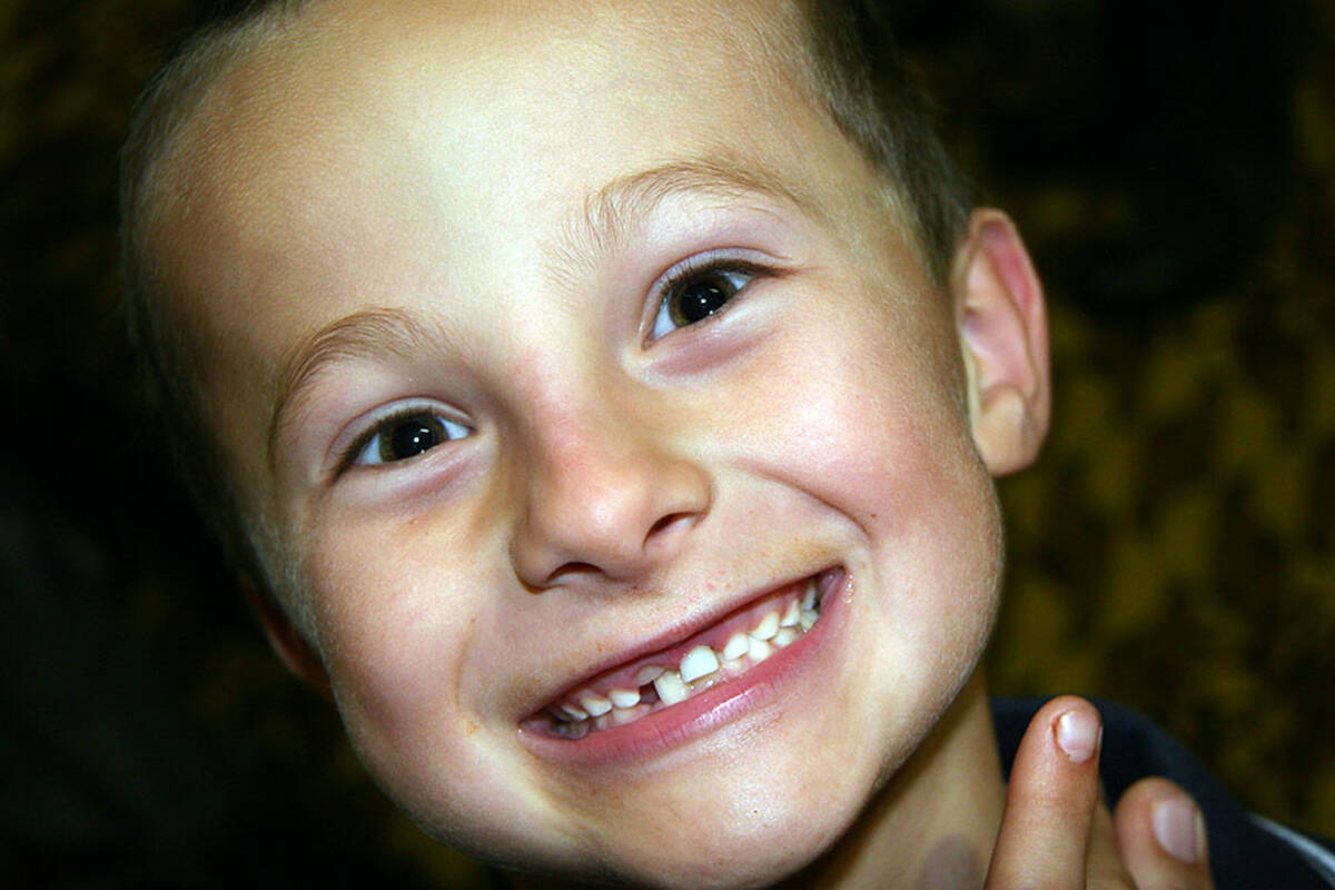 Proteus Syndrome - Positive Exposure