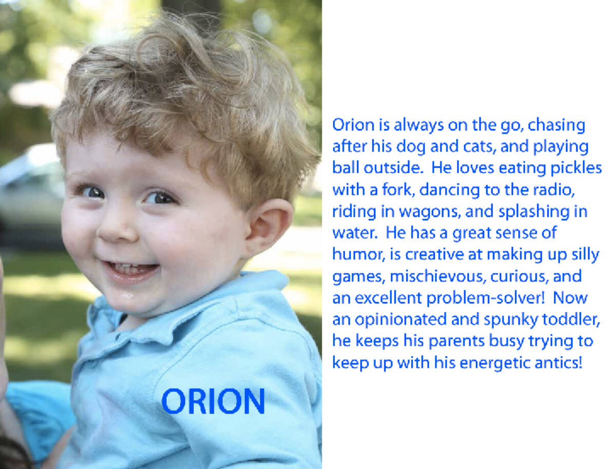 Sacral Agenesis/Caudal Regression Syndrome - Positive Exposure