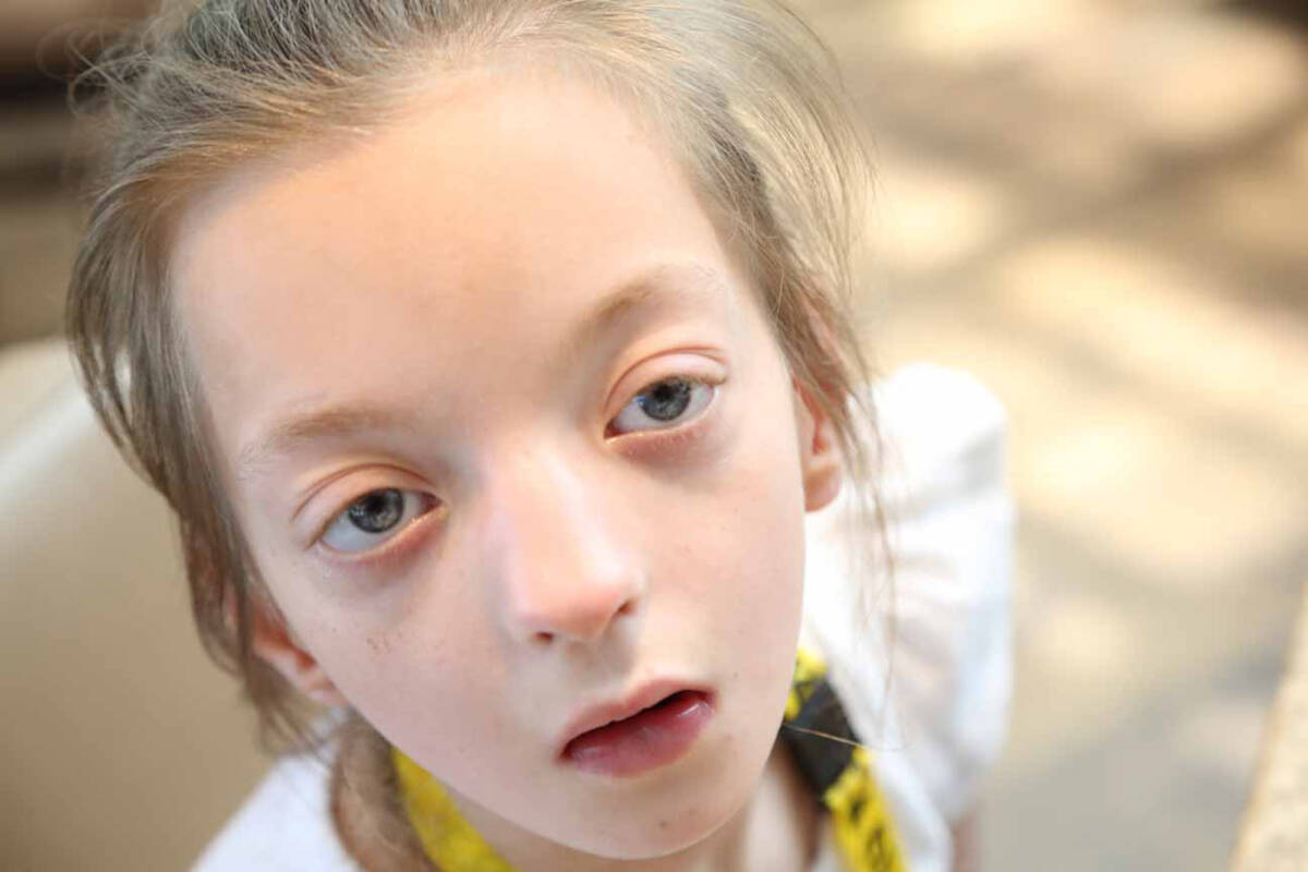Chromosome 4P-, Wolf–Hirschhorn Syndrome - Positive Exposure