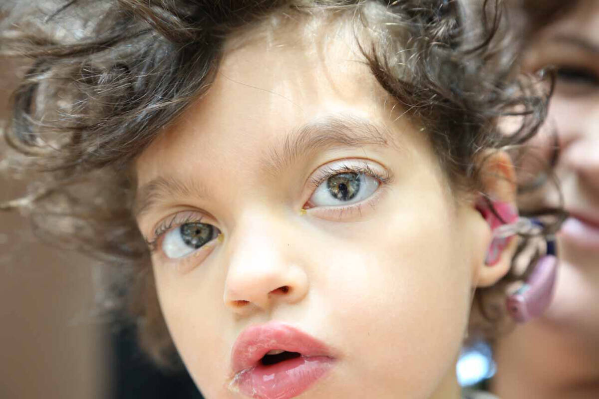 Chromosome 4P-, Wolf–Hirschhorn Syndrome - Positive Exposure
