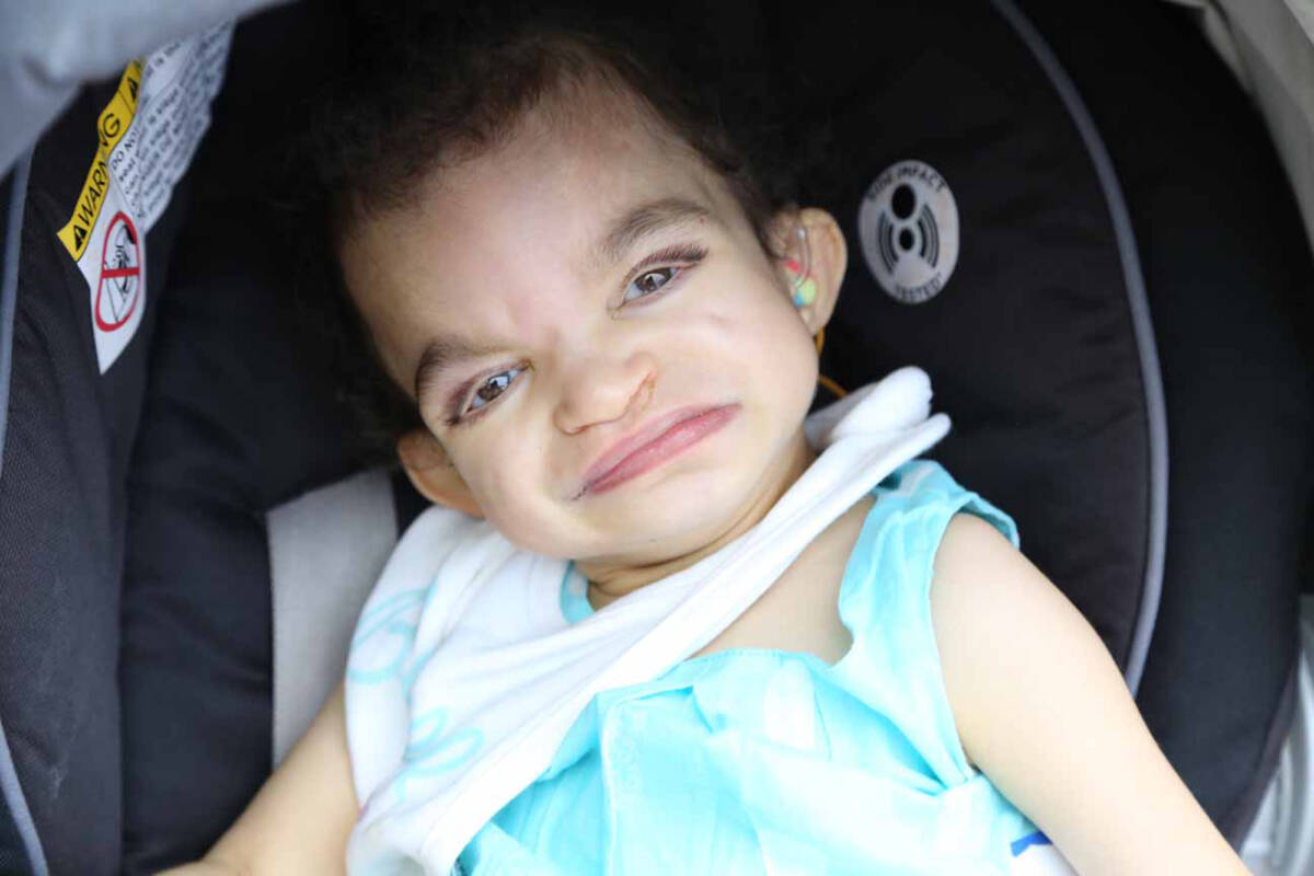 Chromosome 4P-, Wolf–Hirschhorn Syndrome - Positive Exposure