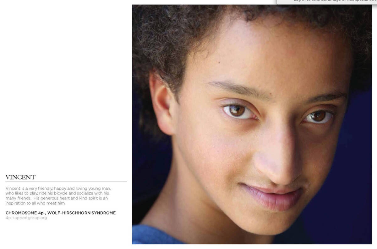 Chromosome 4P-, Wolf–Hirschhorn Syndrome - Positive Exposure