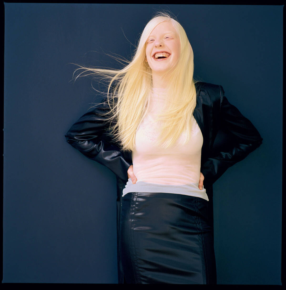 Albinism - Positive Exposure